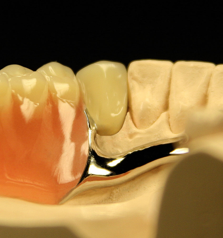 Kombinationsprothesen – Miro & Buntenbach