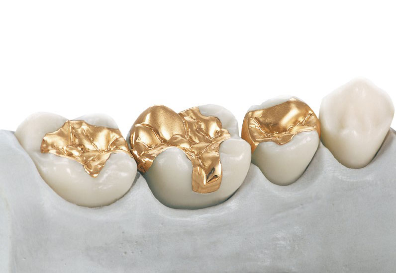 Kronen/Brücken/Teilkronen – Miro & Buntenbach