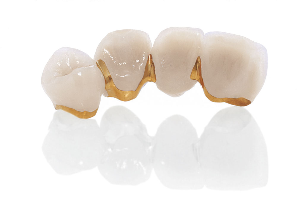 Kronen/Brücken/Teilkronen – Miro & Buntenbach