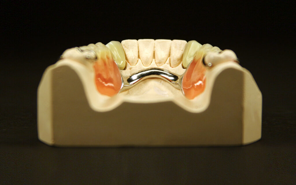 Vollprothesen/Teilprothesen – Miro & Buntenbach